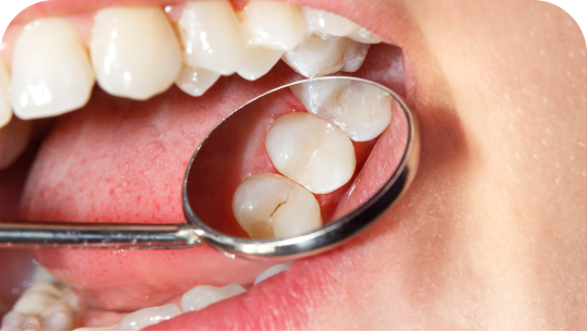 MX Brackets | Tratamientos